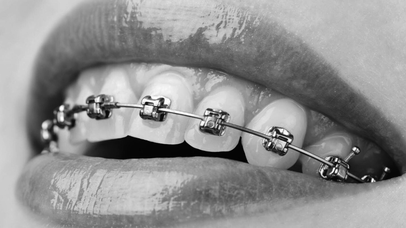 Ortodoncia con brackets en Manresa | Raga Clí­nica dental